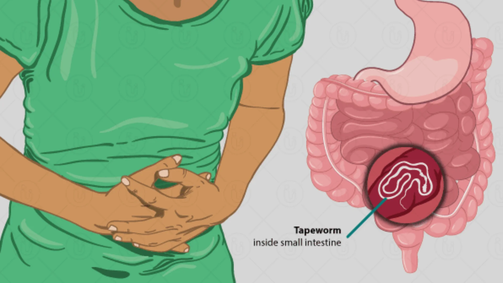 Dealing with Tapeworm Infection | Meri Sehat