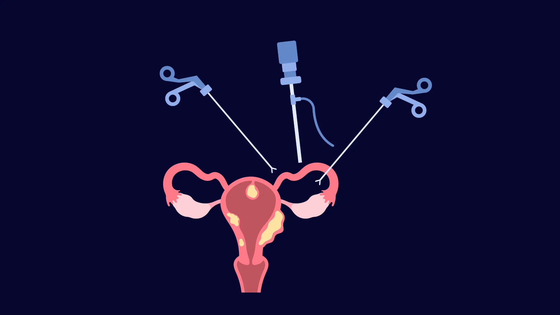 PCOS and Laparoscopy: Effectiveness Explored | Meri Sehat