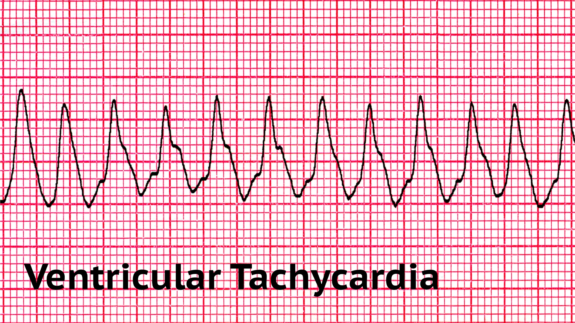 Understanding Ventricular Tachycardia: Causes, Symptoms, and Treatment ...