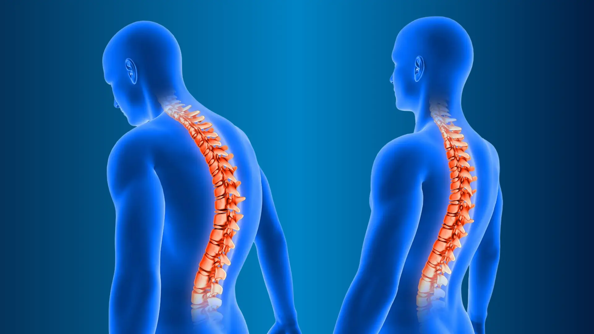 Scheuermann’s Disease: Causes, Symptoms, and Management | Meri Sehat