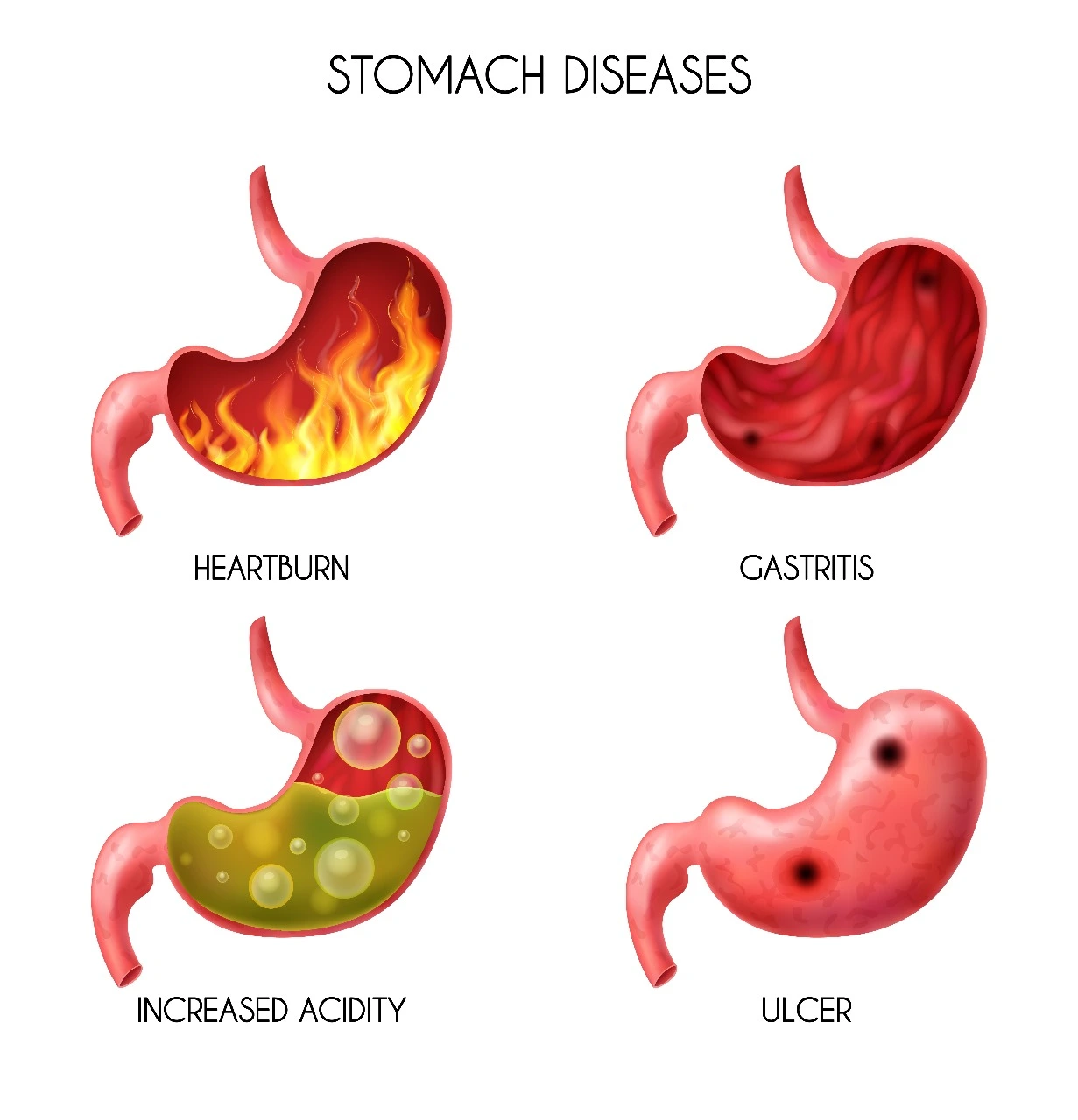Gastritis: Symptoms, Causes, and Treatments | Meri Sehat