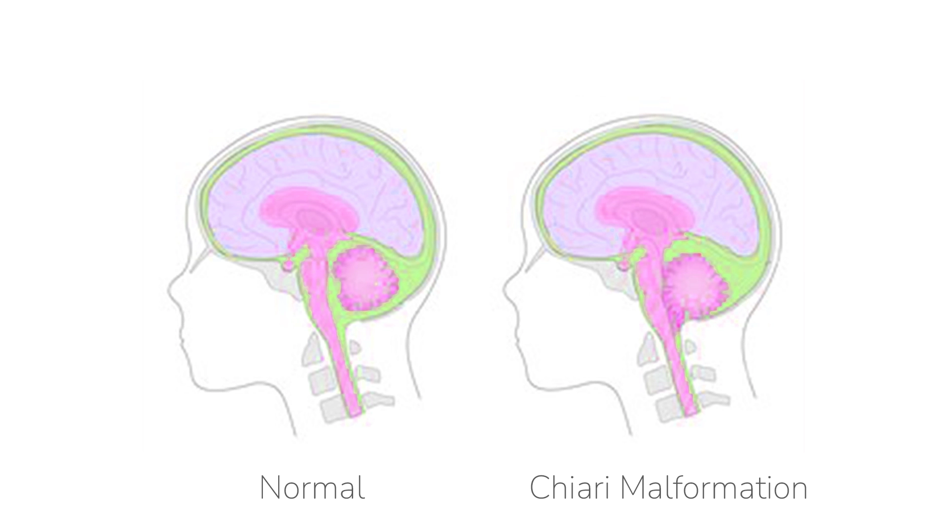 Chiari Malformation: Causes, Symptoms, and Treatment Options | Meri Sehat