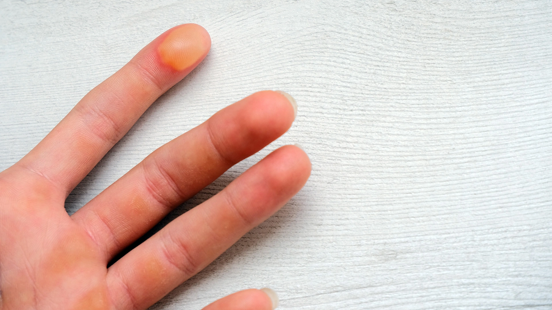 Understanding Blisters and Treatment | Meri Sehat