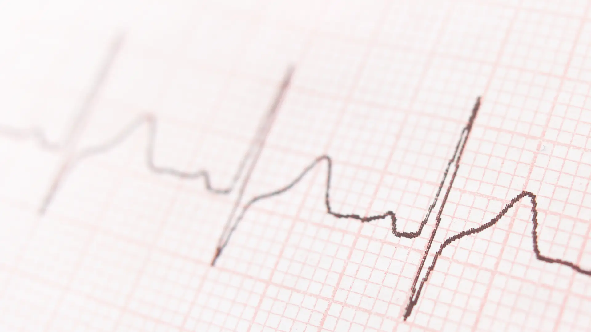 Supraventricular Tachycardia Explained | Meri Sehat