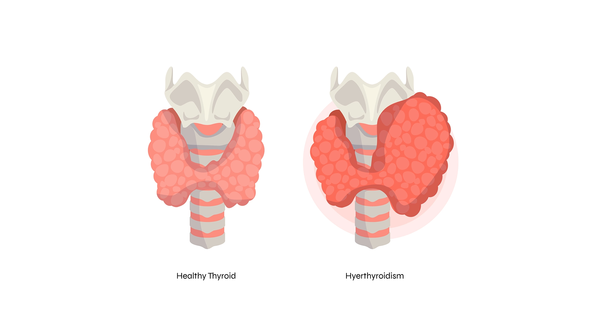 Understanding Hashimoto's Disease: Symptoms, Causes, and Treatment ...