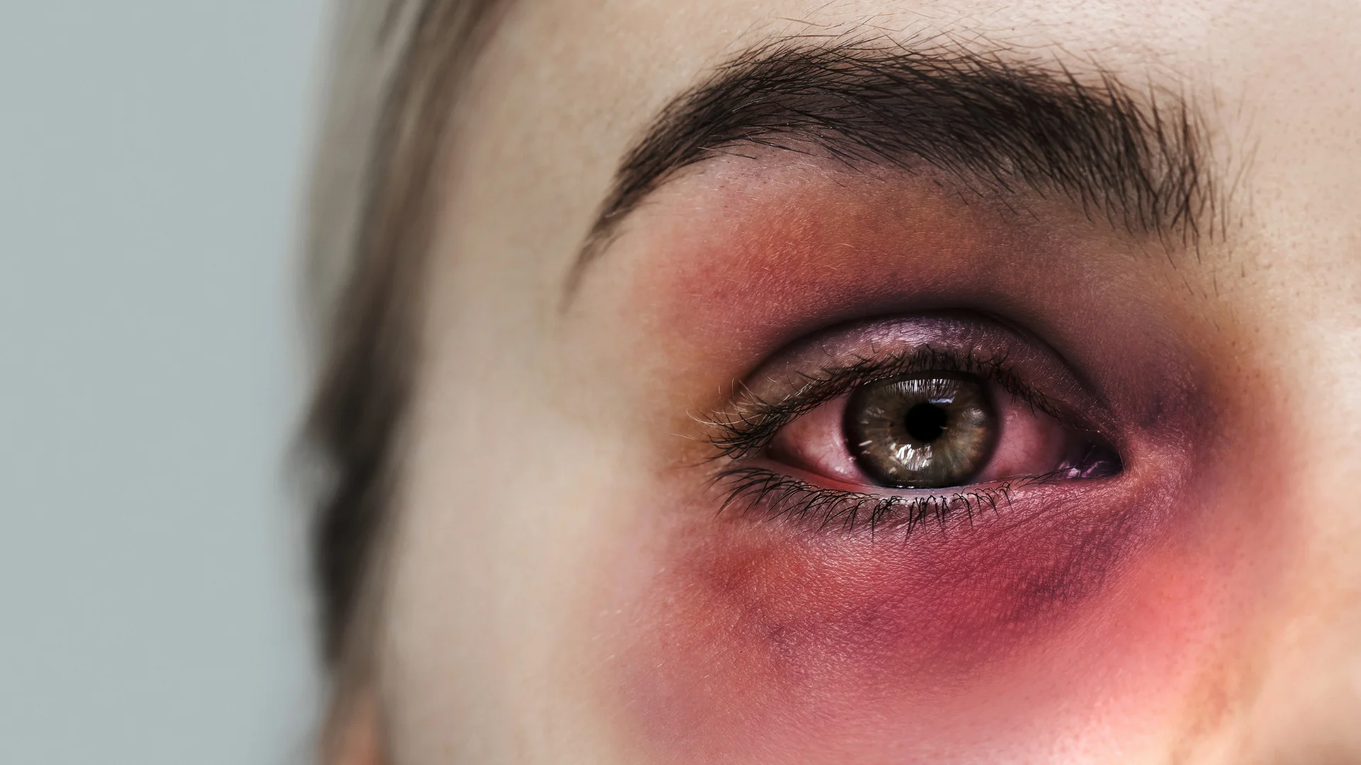 Black Eye: Causes, Symptoms, and Treatment | Meri Sehat