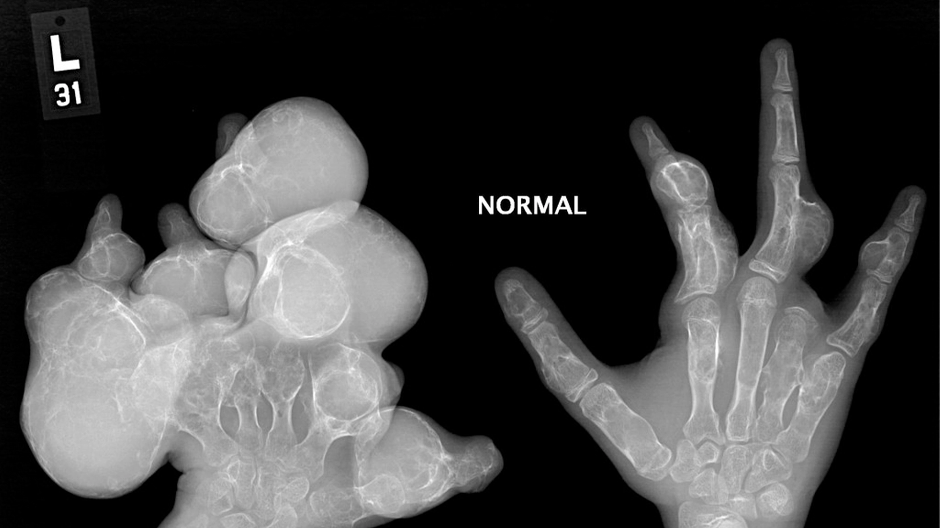 Ollier Disease | Symptoms | Causes | Treatment | Meri Sehat