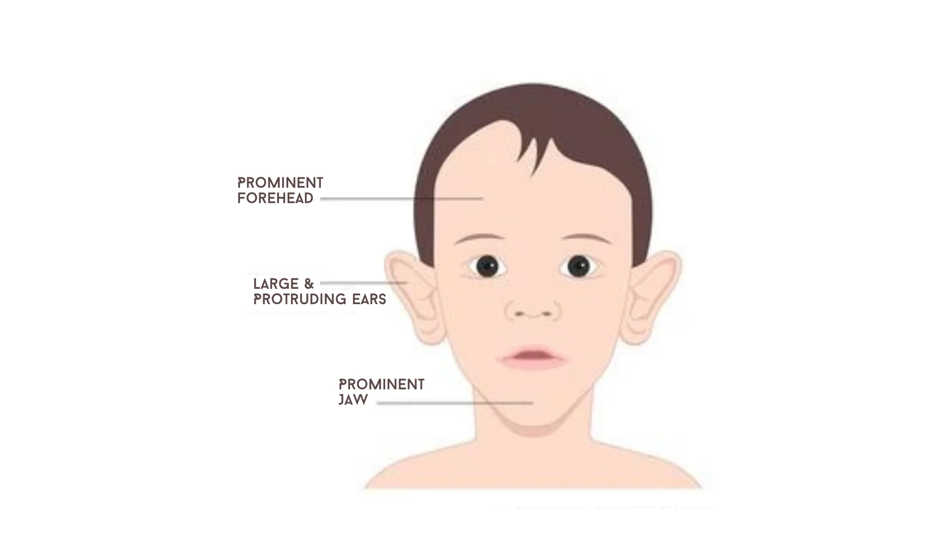 Understanding Triple X Syndrome: Insights and Support | Meri Sehat